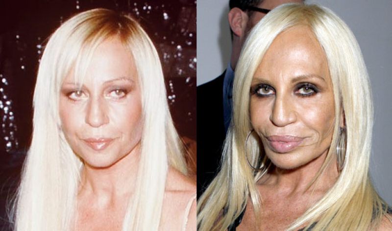DONATELLA VERSACE: 5 Schönheiten, die es mit Beauty-OPs übertrieben haben